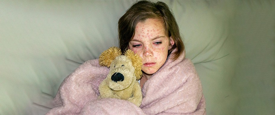 Odra - choroba zakaźna, powikłania, objawy i leczenie zakażenia ...