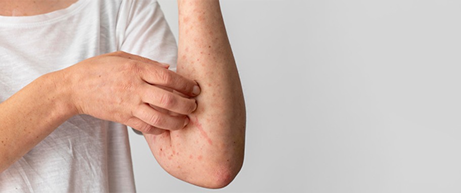 Wysypka alergiczna na ciele - objawy i leczenie alergii skórnej ...