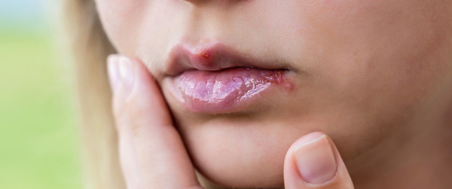 Zajady – przyczyny i leczenie zajadów. Jak powstają zajady i jakie ...